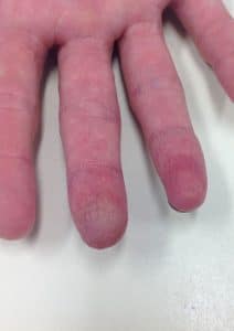 Hand Scar Management Mackay | Upper Limbs & Beyond