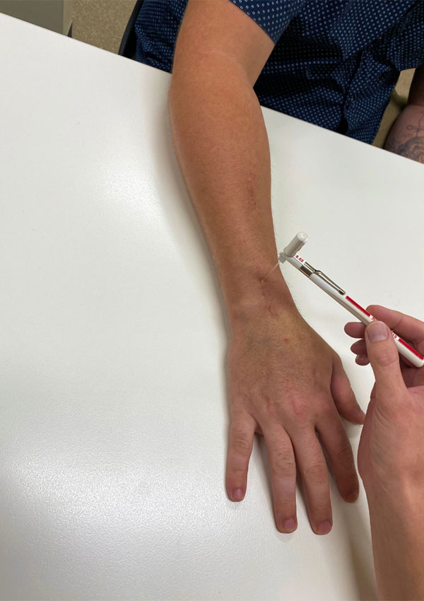 Hand Loss of Sensation Treatment Mackay | Upper Limbs & Beyond