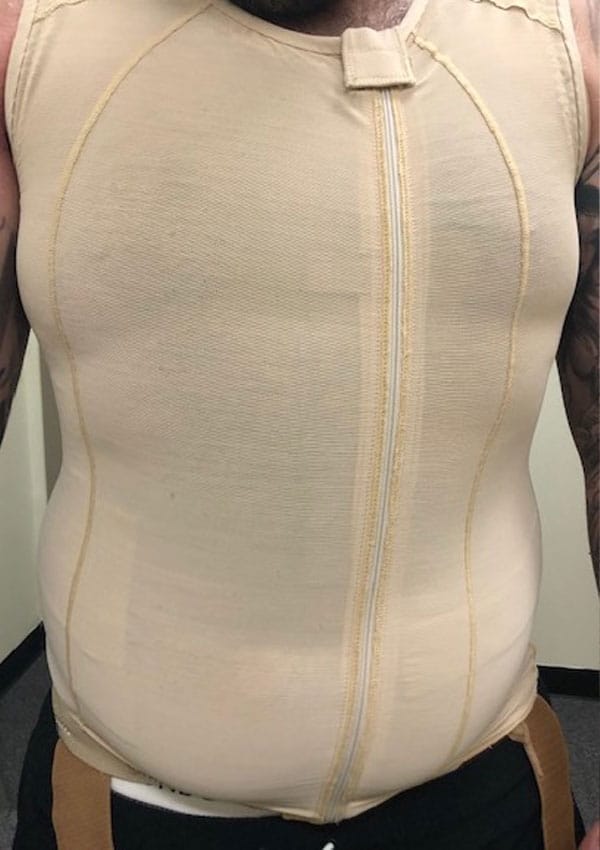 Burns Management Mackay | Upper Limbs & Beyond