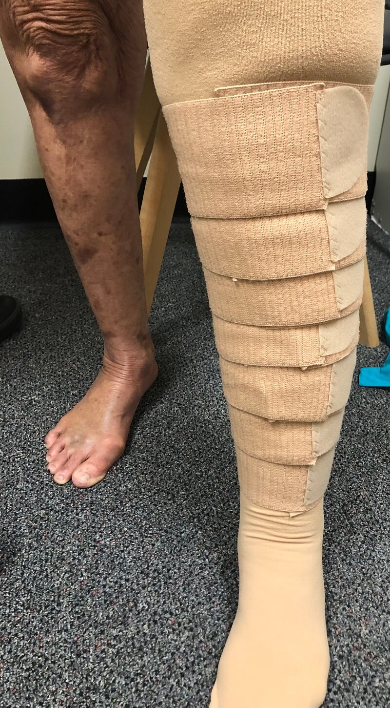 Swelling Control Treatment Mackay | Upper Limbs & Beyond